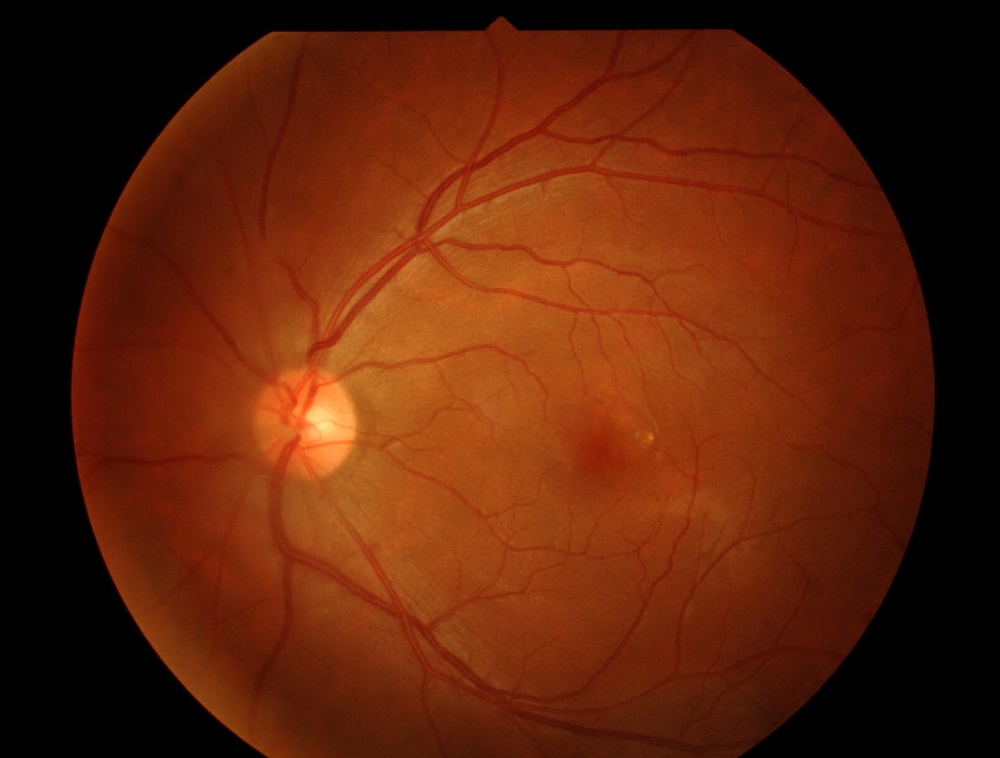 Retinal Imaging | Larkspur Landing Optometry